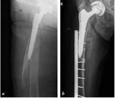 Resultaten van de operatieve behandeling van periprothetische ...