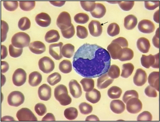 Tangier Disease | SpringerLink