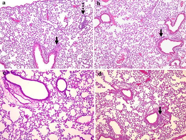 The B-cell superantigen Finegoldia magna protein L causes pulmonary ...
