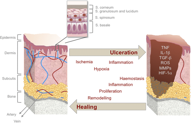 Pathogenesis of skin ulcers: lessons from the Mycobacterium ulcerans ...