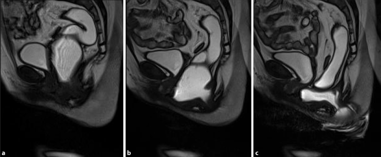 Rektozele | SpringerLink