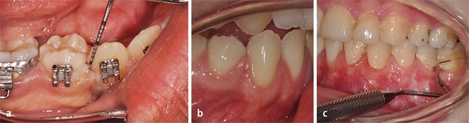 Gingival invagination—a systematic review | SpringerLink