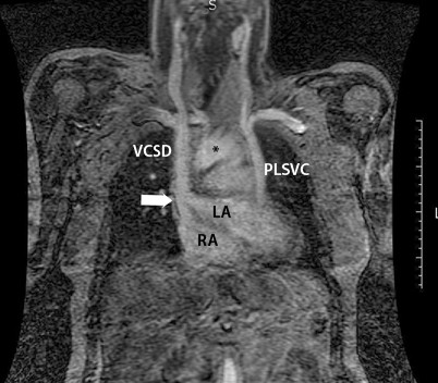 Persistent left superior vena cava, absence of the innominate vein, and ...