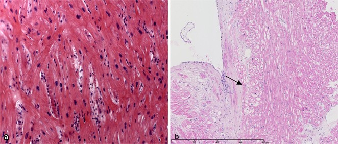 Danon disease | SpringerLink
