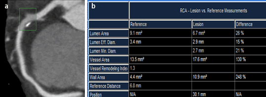 Progression of coronary artery disease | SpringerLink