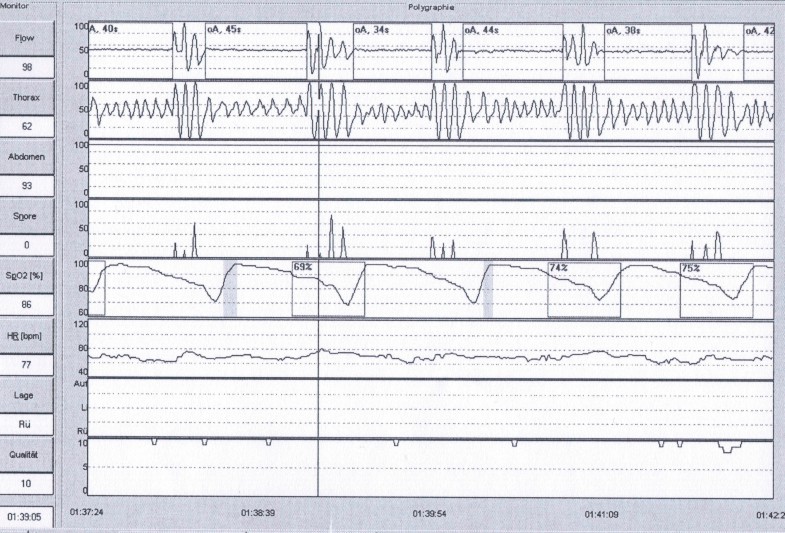Die ambulante Polygraphie richtig eingesetzt | SpringerLink