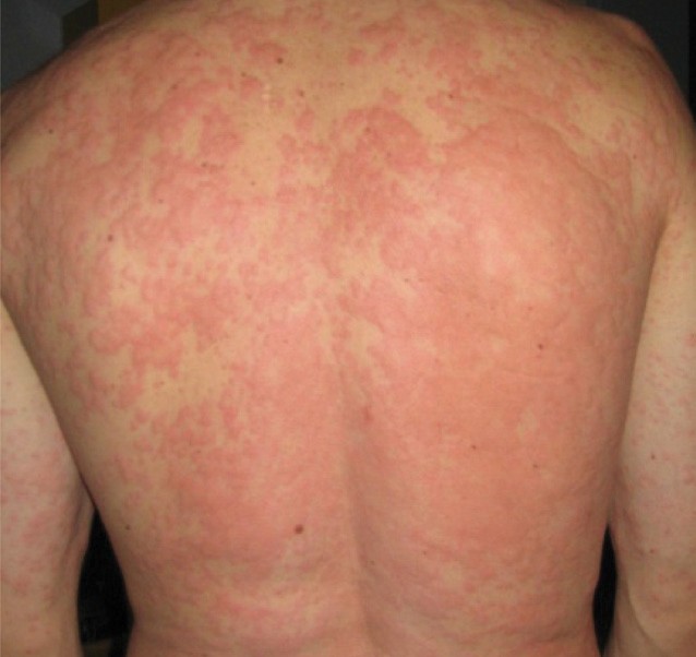 Was steckt hinter den juckenden Quaddeln? | SpringerLink