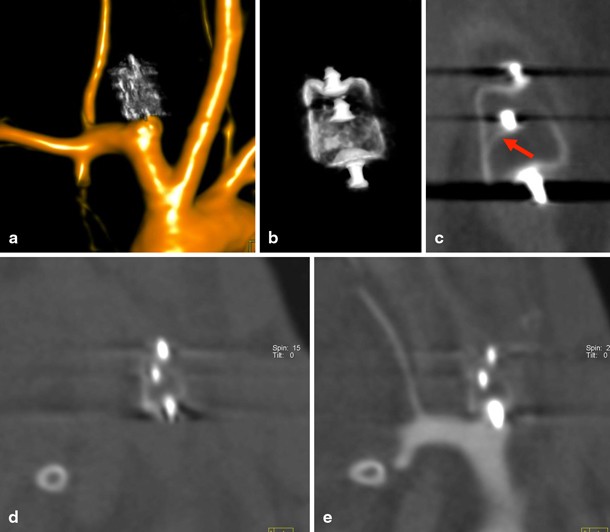Angiographic C-arm CT visualization of the Woven EndoBridge Cerebral ...
