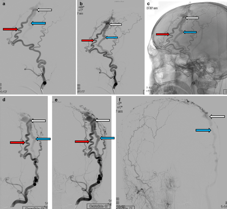 Scalp Arteriovenous Fistula Following Hair Transplantation | SpringerLink