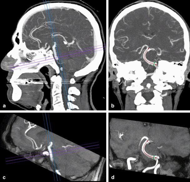 A Comparison of CT/CT Angiography and MRI/MR Angiography for Imaging of ...