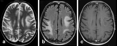 Differential Diagnosis of White Matter Lesions: Nonvascular Causes—Part ...