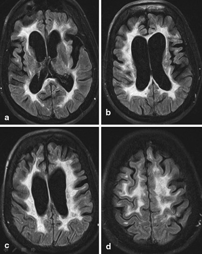 Differential Diagnosis of White Matter Lesions: Nonvascular Causes—Part ...