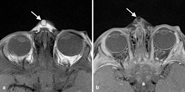 Diagnostic Imaging Features of Congenital Nose and Nasal Cavity Lesions ...