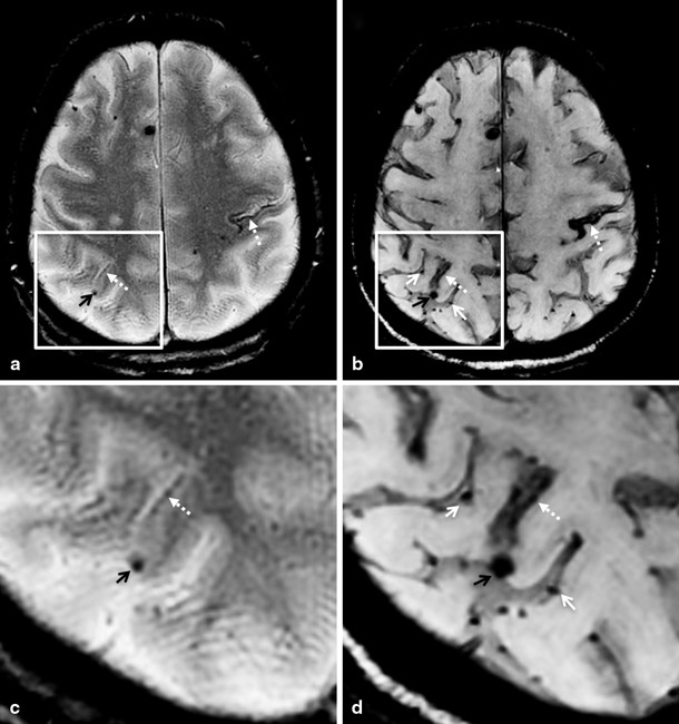Imaging of Cerebral Microbleeds | SpringerLink