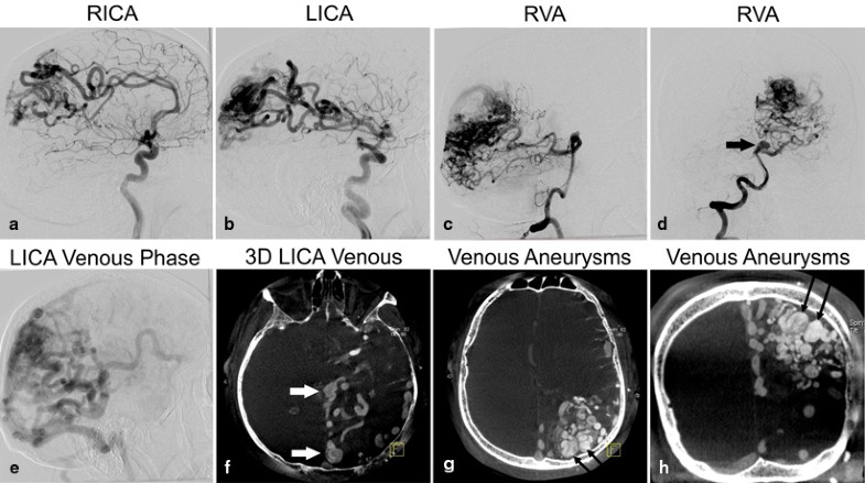 Combined DSA and 4D Flow Demonstrate Overt Alterations of Vascular ...