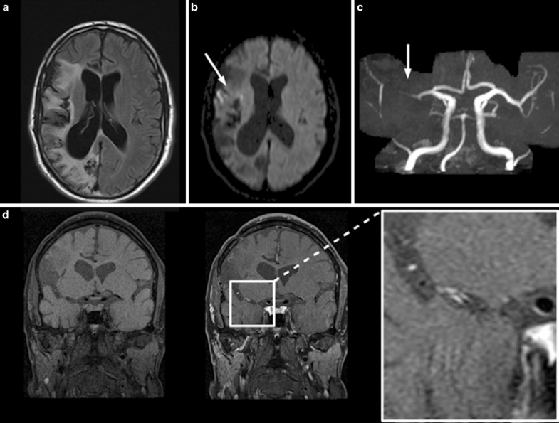 Neuroradiologic Characteristics of Primary Angiitis of the Central ...