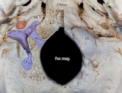 Endovascular Treatment of Dural Arteriovenous Fistulas of the Anterior ...