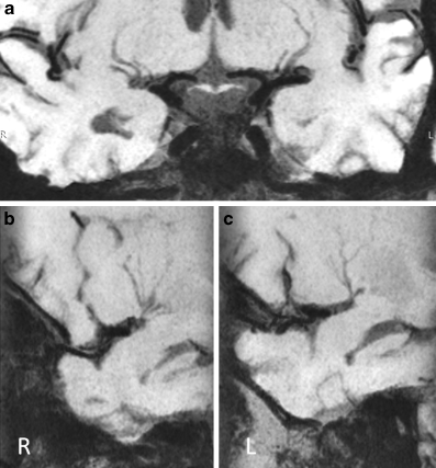 Cerebral Perforating Artery Disease | SpringerLink