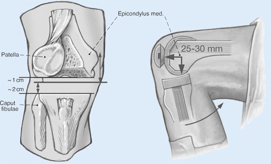 Knie-TEP-Revision auf ein halbgekoppeltes Prothesensystem mit der 3 ...