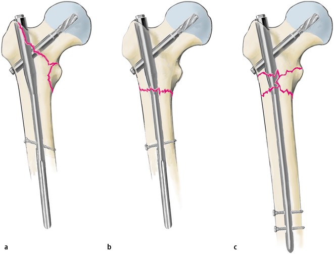 Stabilisierung sub- und pertrochantärer Femurfrakturen mit dem PFNΑ® | SpringerLink