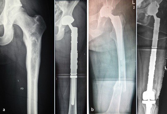 Der proximale und komplette Femurersatz | SpringerLink