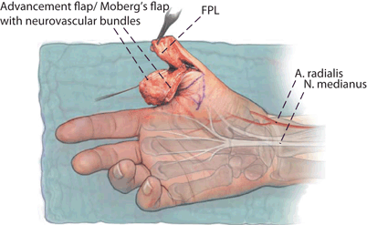 Reconstruction of the thumb tip using palmar neurovascular flaps ...
