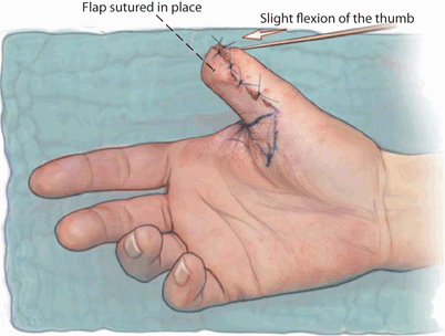Reconstruction of the thumb tip using palmar neurovascular flaps ...