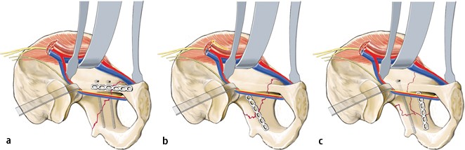 The Stoppa approach for acetabular fracture | SpringerLink