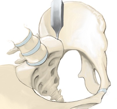 The Stoppa approach for acetabular fracture | SpringerLink