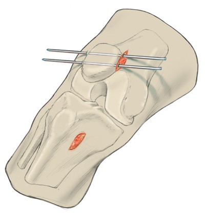 Anatomische Rekonstruktion des medialen patellofemoralen Bands mit ...