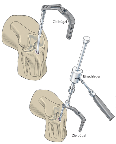 Intramedulläre Nagelung von proximalen Tibiafrakturen | SpringerLink