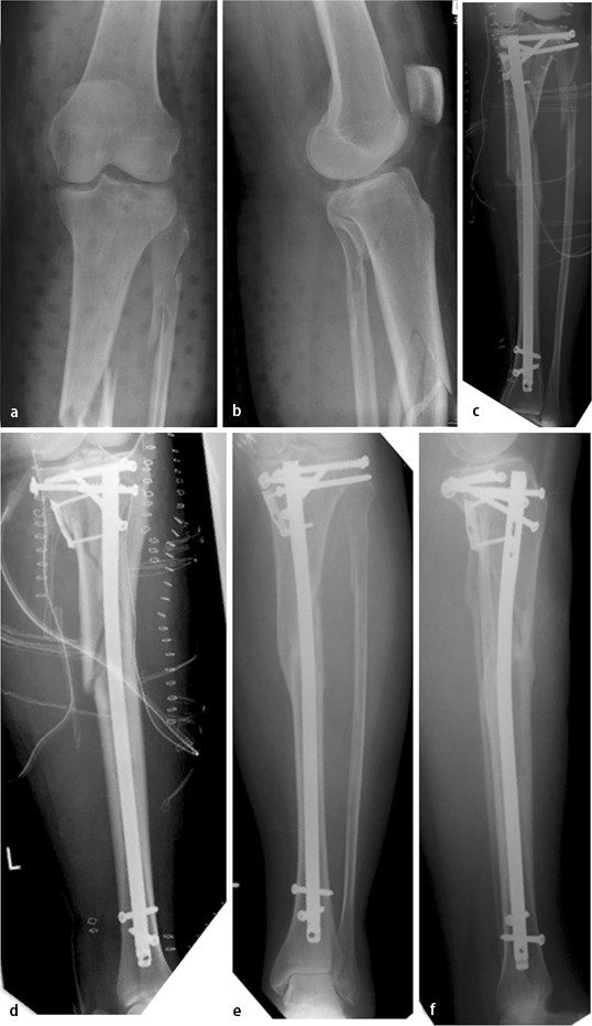 Intramedulläre Nagelung von proximalen Tibiafrakturen | SpringerLink