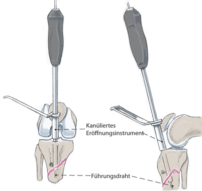 Intramedulläre Nagelung von proximalen Tibiafrakturen | SpringerLink
