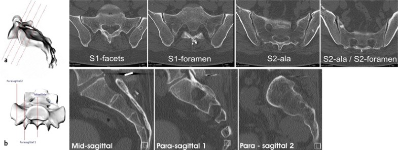 Reinforcement of lumbosacral instrumentation using S1–pedicle screws ...