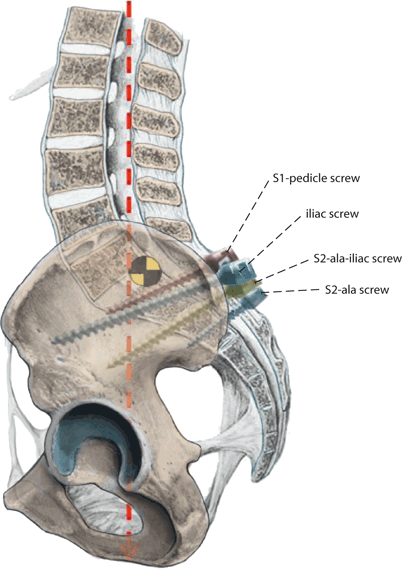 Reinforcement of lumbosacral instrumentation using S1–pedicle screws ...