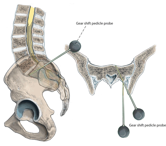 Reinforcement of lumbosacral instrumentation using S1–pedicle screws ...