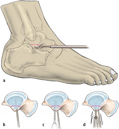 Minimal-invasive Osteosynthese | SpringerLink