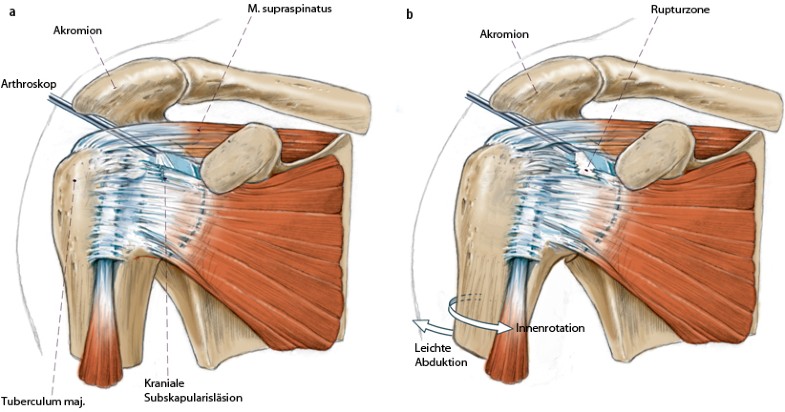 Die isolierte Subskapularisruptur | SpringerLink
