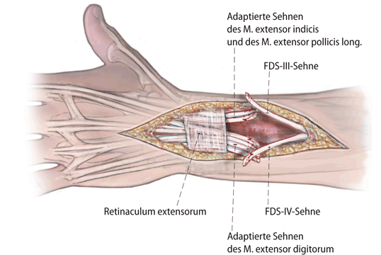 Transposition der oberflächlichen Beugesehnen von Mittel- und ...