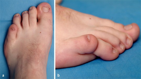 Transfer der Extensor-digitorum-longus-Sehne zur Behandlung des ...