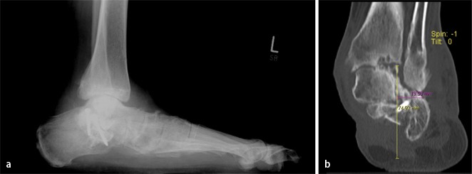 Arthrodese (mit/ohne Korrektur) des oberen und unteren Sprunggelenks ...