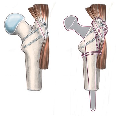 Die operative Versorgung der sekundären Coxarthrose bei kongenitaler ...