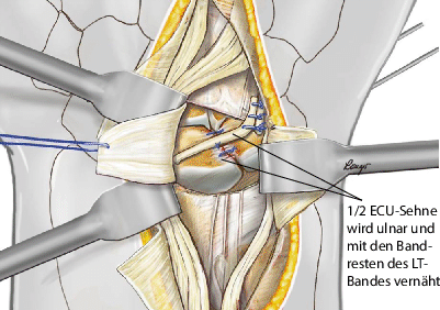 Die Bandersatzplastik bei lunotriquetraler Instabilität mit einem ...