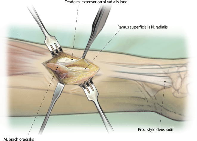 Die operative Dekompression des Ramus superficialis des Nervus radialis ...