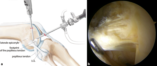 Arthroscopic popliteus bypass graft for posterolateral instabilities of ...