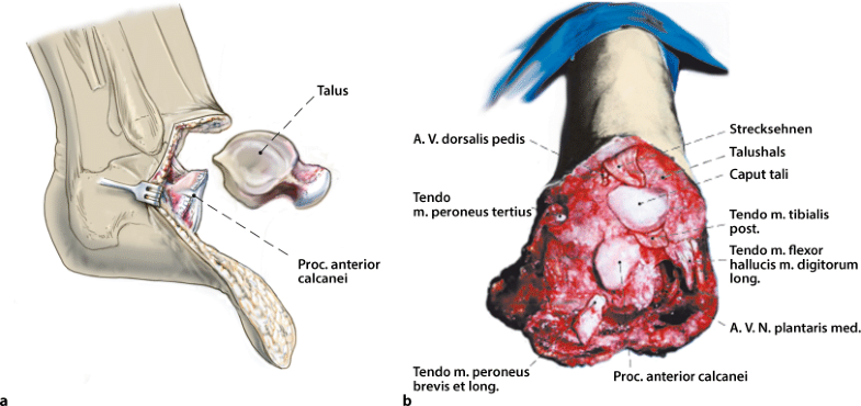 Modifizierte Pirogoff-Amputation | SpringerLink
