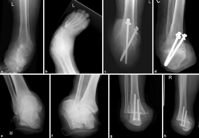 Modifizierte Pirogoff-Amputation | SpringerLink