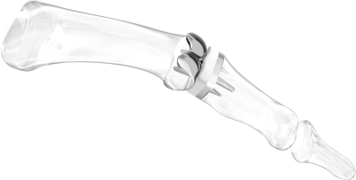 Oberflächenersatz am Fingermittelgelenk mittels CapFlex-PIP | SpringerLink