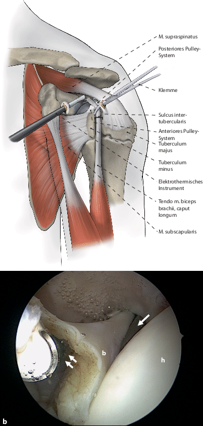 Arthroskopische suprapektorale Tenodese der langen Bizepssehne am ...