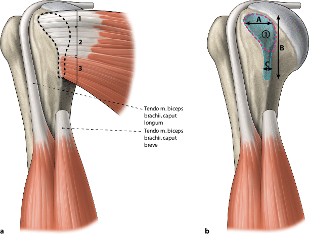 Arthroskopische Doppelreihenrekonstruktion hochgradiger Rupturen der ...